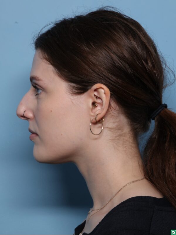 Real Patient Case: 3288 - Smith Facial Plastics - Columbus, OH