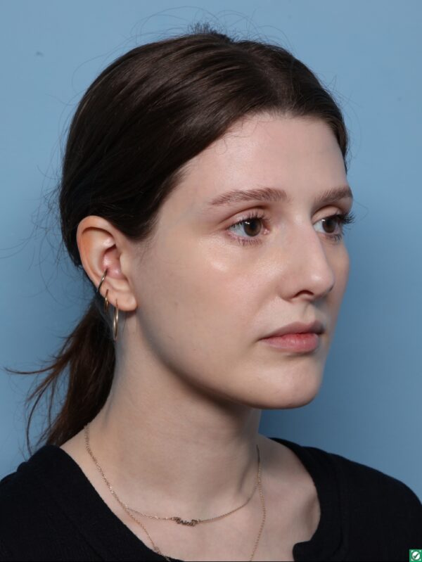 Real Patient Case: 3288 - Smith Facial Plastics - Columbus, OH