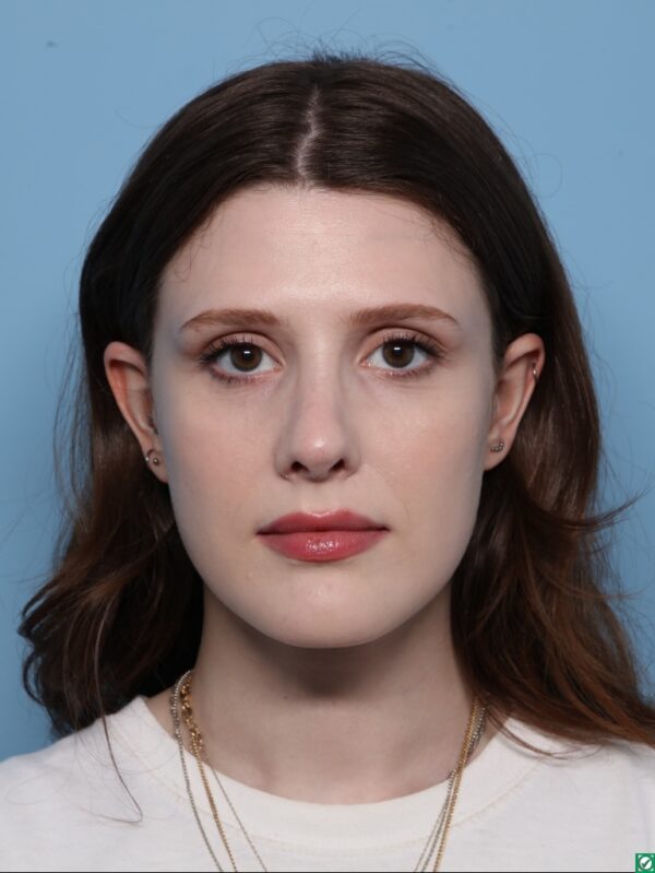 Real Patient Case: 3288 - Smith Facial Plastics - Columbus, OH